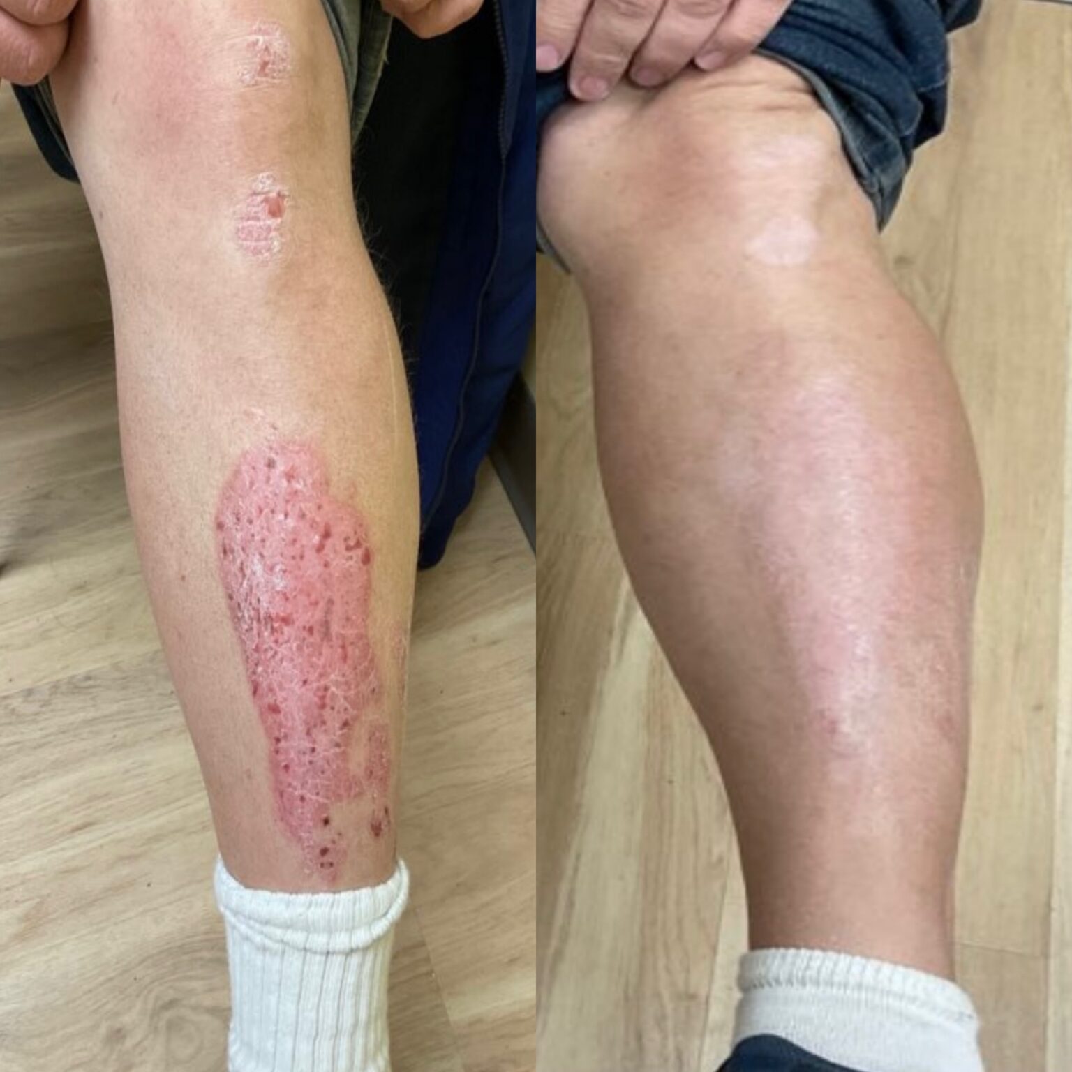 Psoriasis - Dermatology Duluth